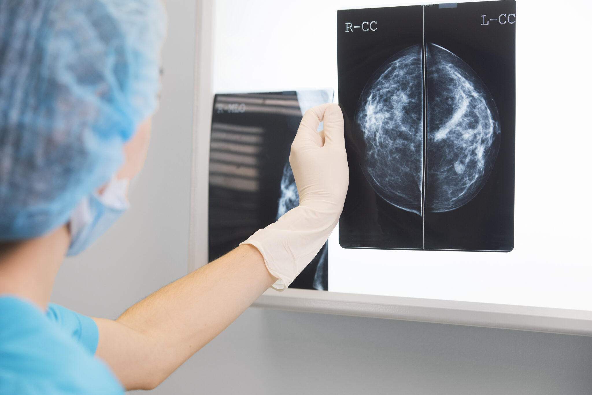 Mammography Reporting Now Requires Breast Density Assessment - North ...